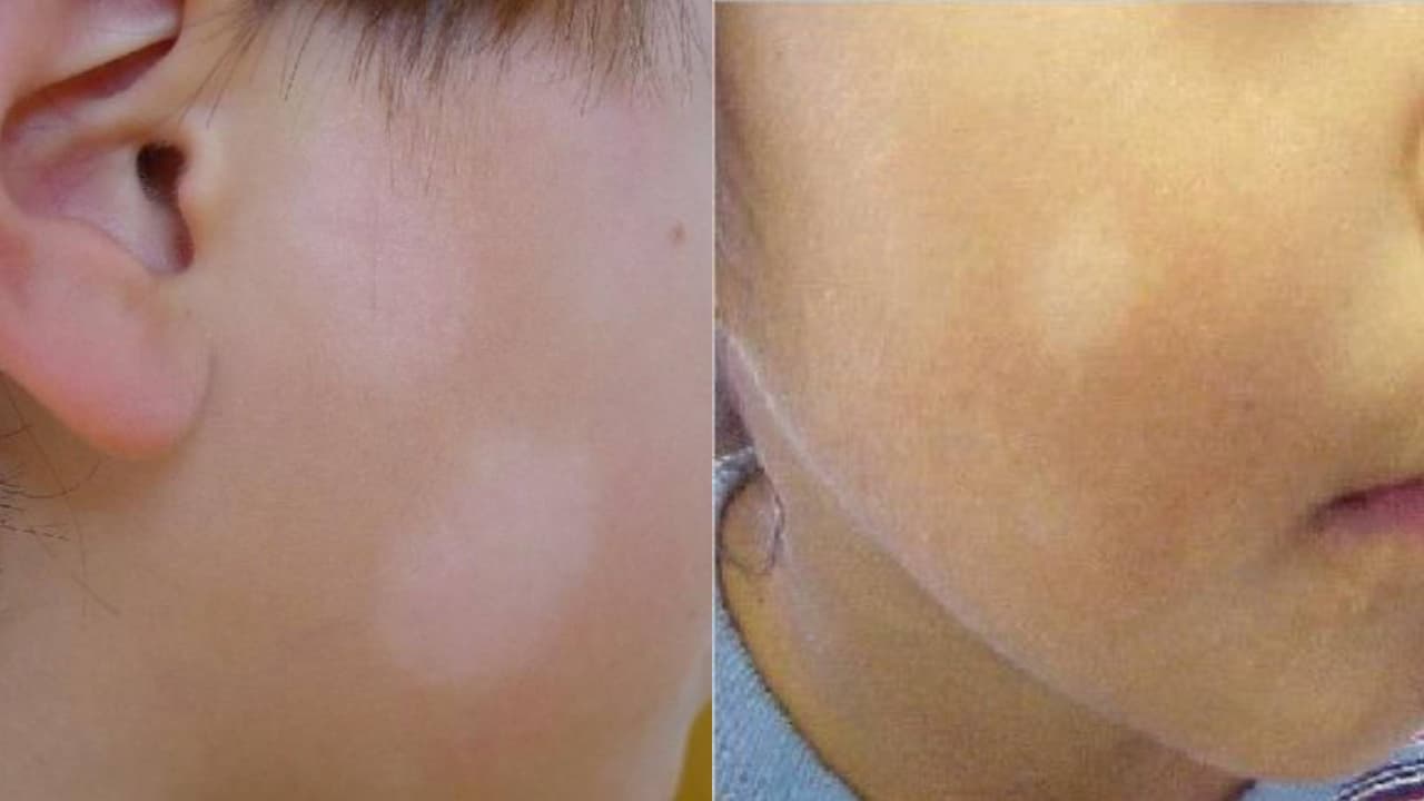 Child skincare: Seeing white patches on your kid's skin this summer ...