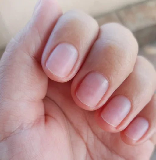 Hábito de roer unhas pode aumentar risco de infecção por parasitas