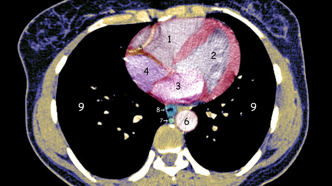 MRI heart scans may predict future cancer risk, UCLA study finds