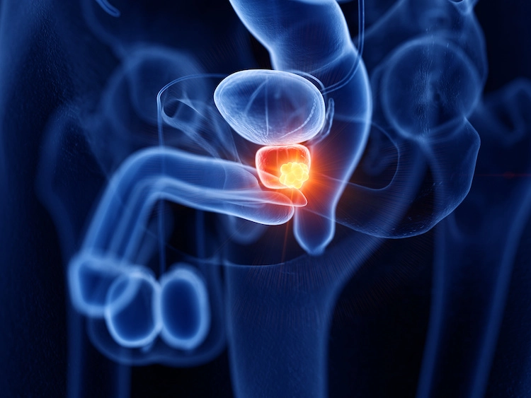 Tumore alla prostata: un nuovo protocollo di screening evita inutili ...