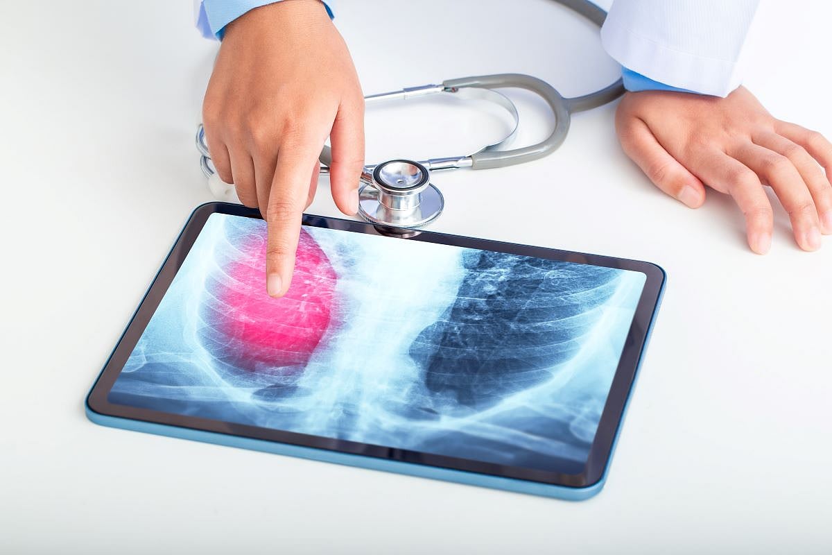 Mesothelioma diagnoses and deaths still increasing