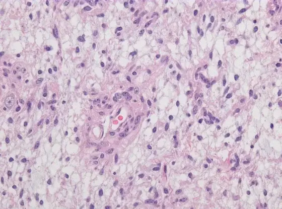 New AI system identifies 102 brain tumor types in minutes instead of weeks