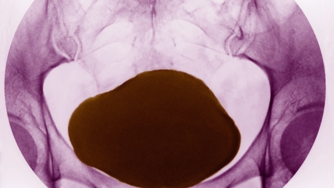 Bladder cancer symptoms, diagnosis, and treatment advances