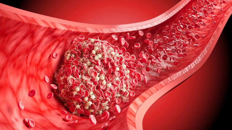FDA clears Penumbra’s Thunderbolt thrombectomy platform for stroke