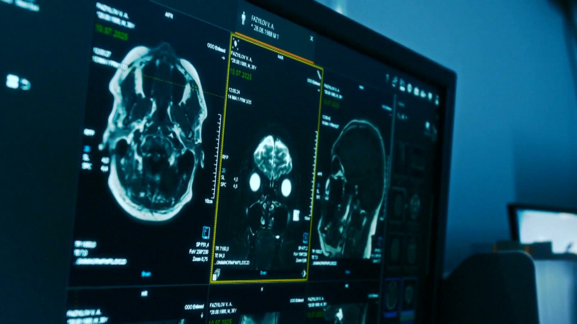 GLP-1 does not slow Alzheimer's, research shows