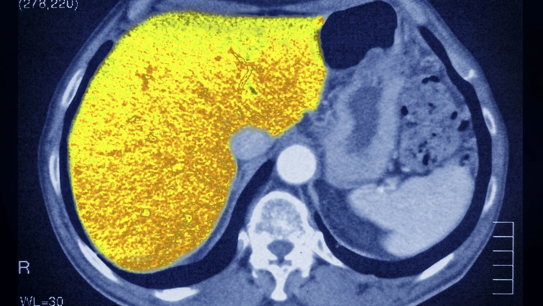 Understanding fatty liver disease and its impact