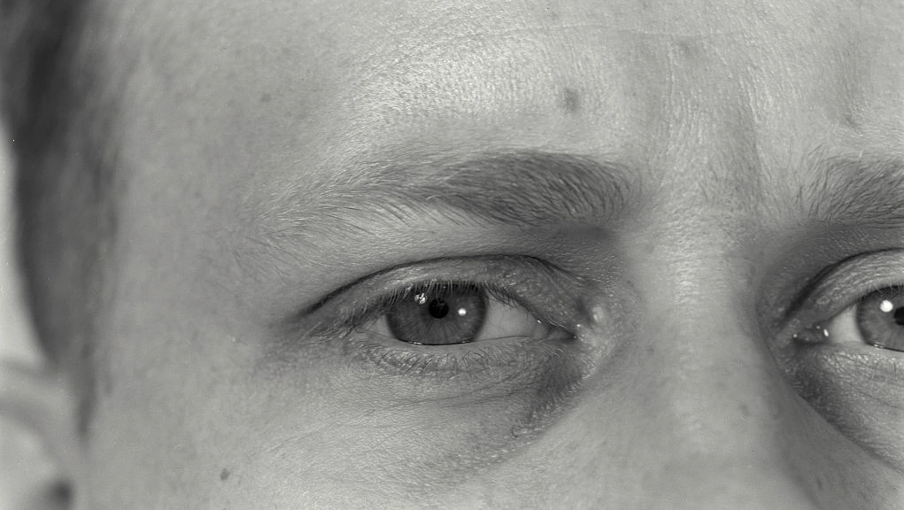 Living with rare conditions that prevent blinking