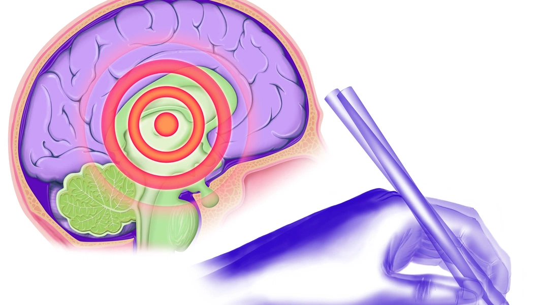 8 early signs of Parkinson's disease