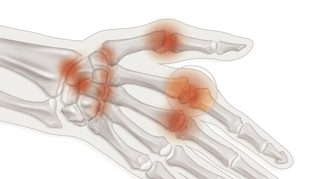 16 foods that can worsen arthritis symptoms