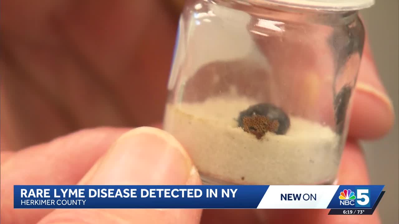 Rare case of Lyme disease detected in NY