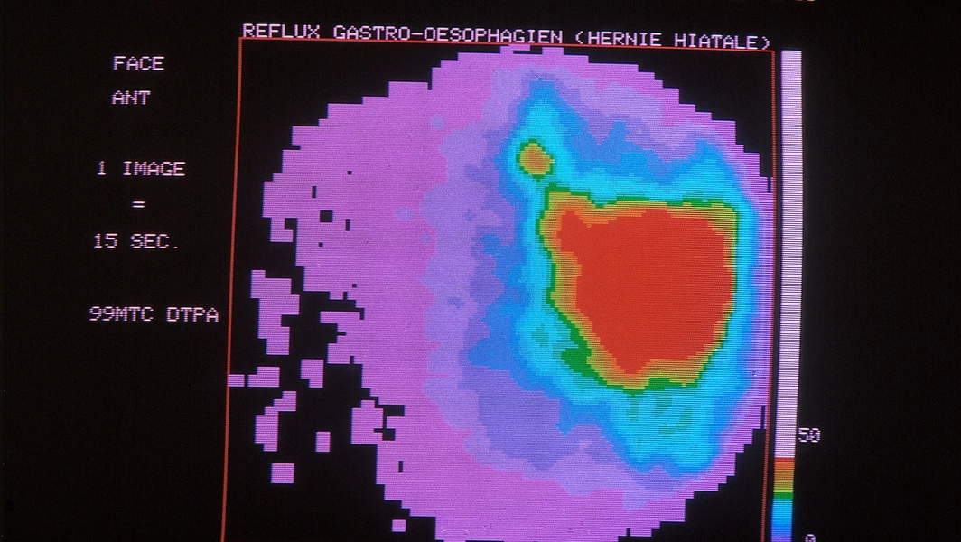 Understanding acid reflux and GERD