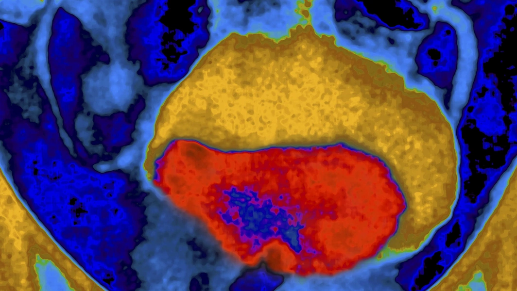 Subtle warning signs of prostate cancer