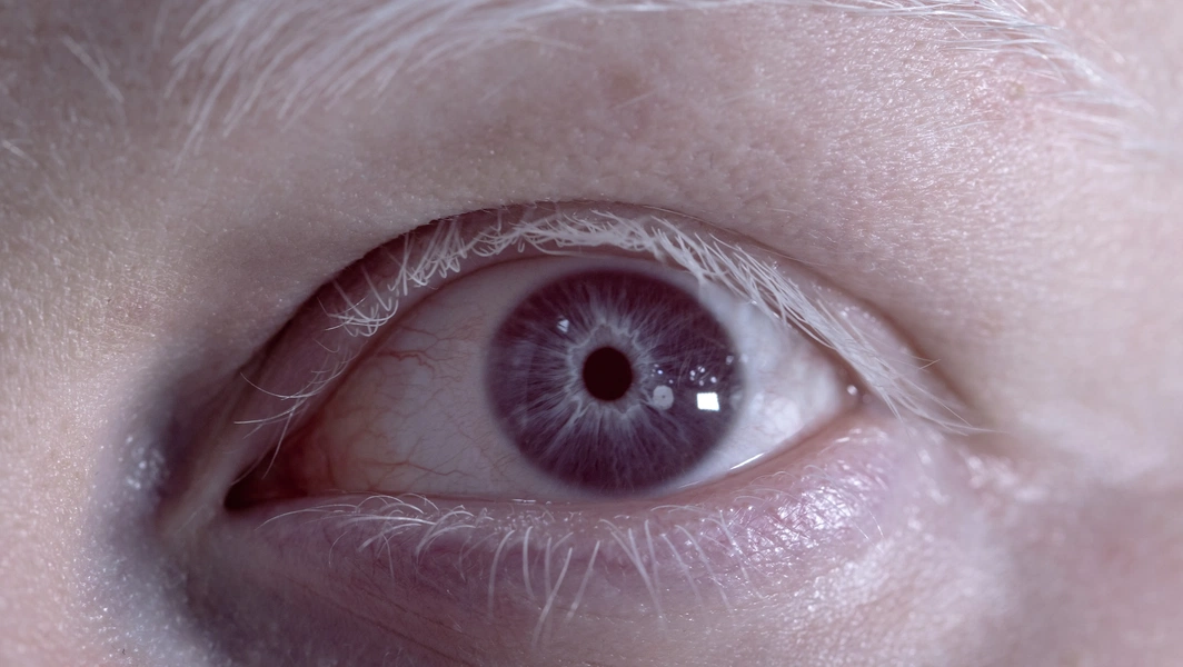 9 fascinating rare genetic traits and disorders