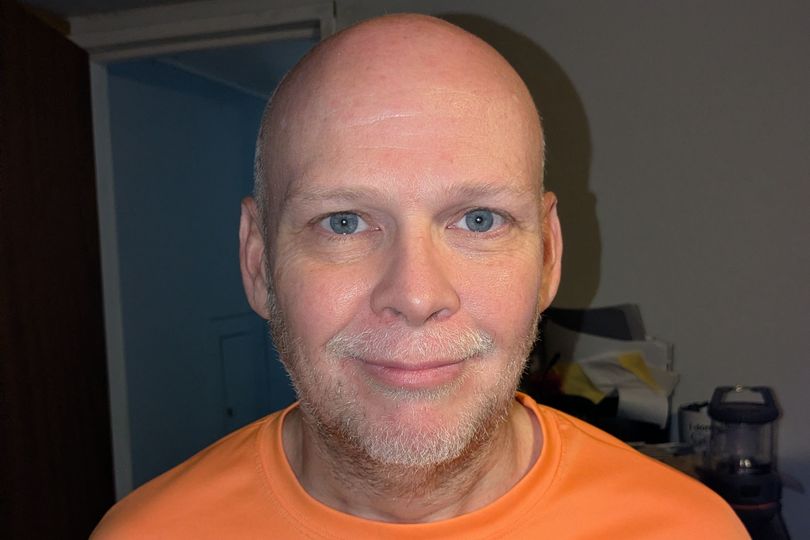 Single dad can't eat solid food after half his teeth rotted in 'domino ...