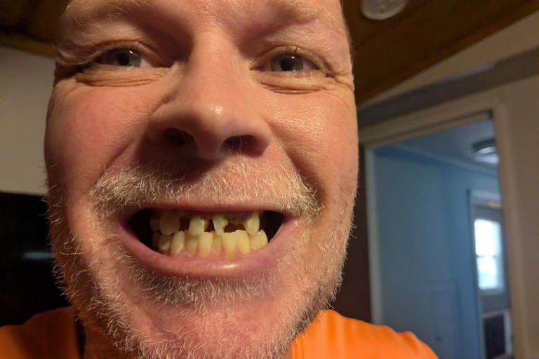 Single dad can't eat solid food after half his teeth rotted in 'domino ...