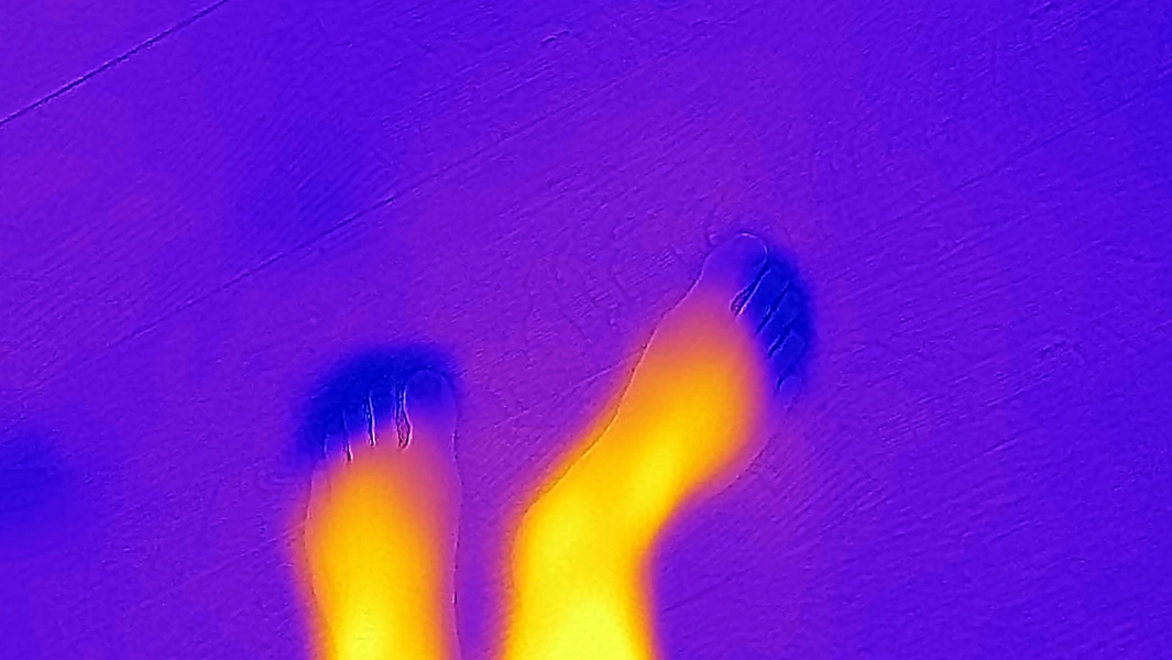 Understanding persistent cold sensitivity
