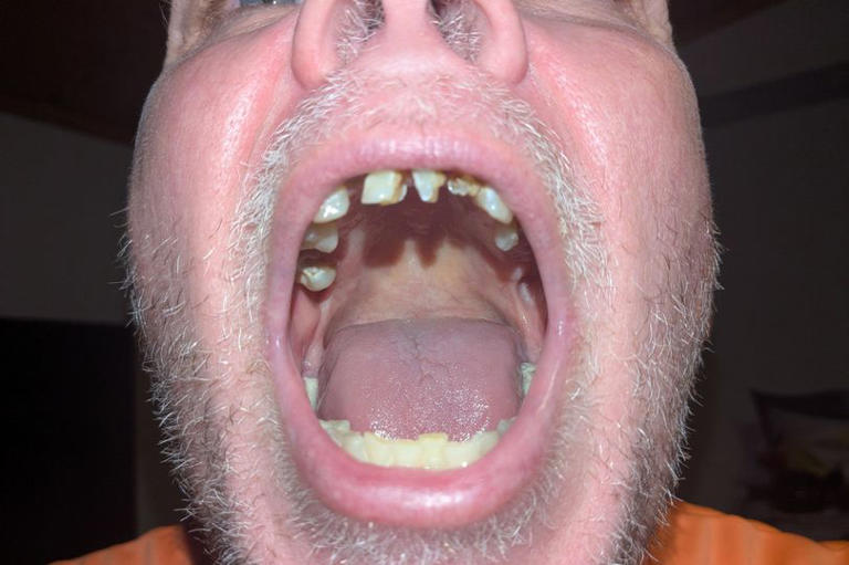 Single dad can't eat solid food after half his teeth rotted in 'domino ...