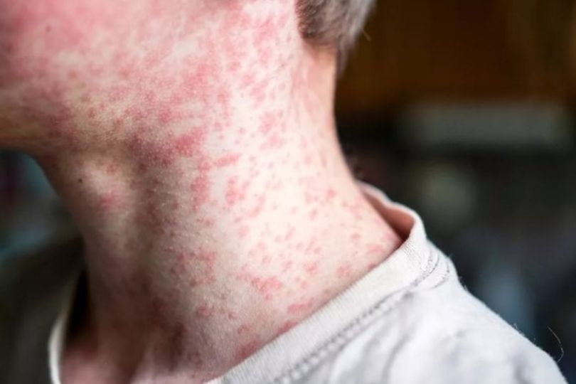 UK measles update with urgent warning to parents as over 100 new cases ...