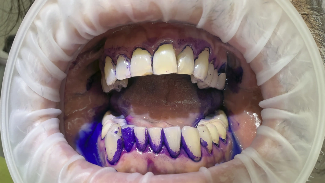 15 common foods and drinks that stain teeth
