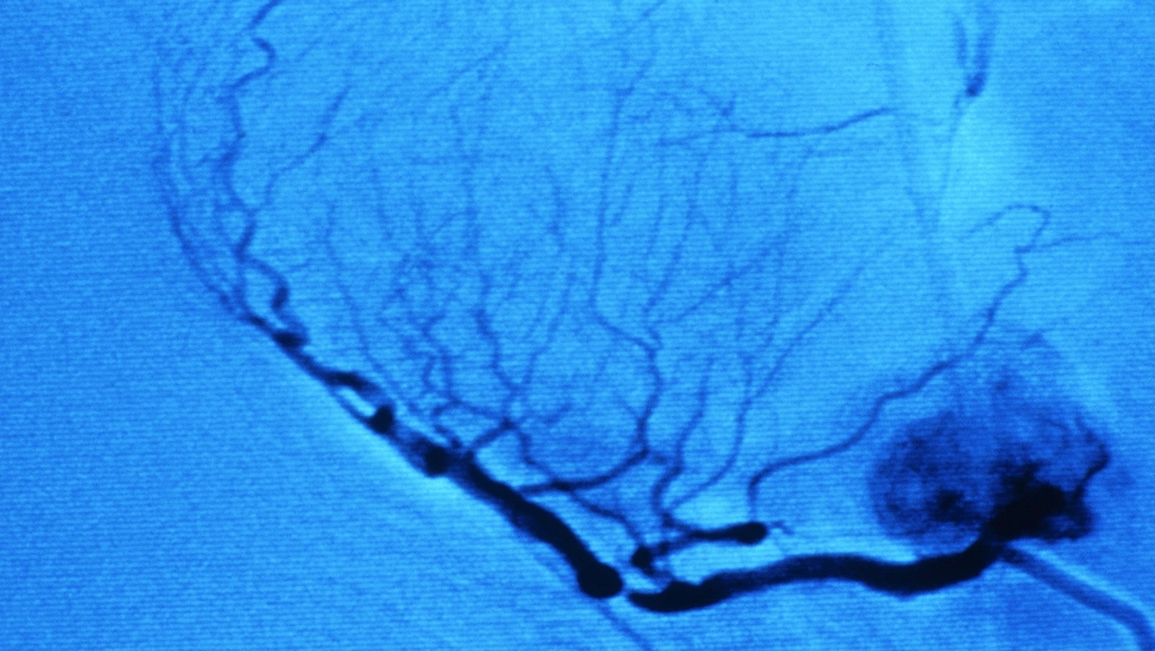 Recognizing symptoms of artery blockages