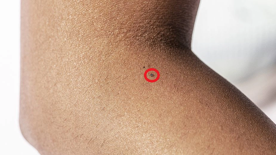 Rare Lyme disease bacterium detected in New York ticks
