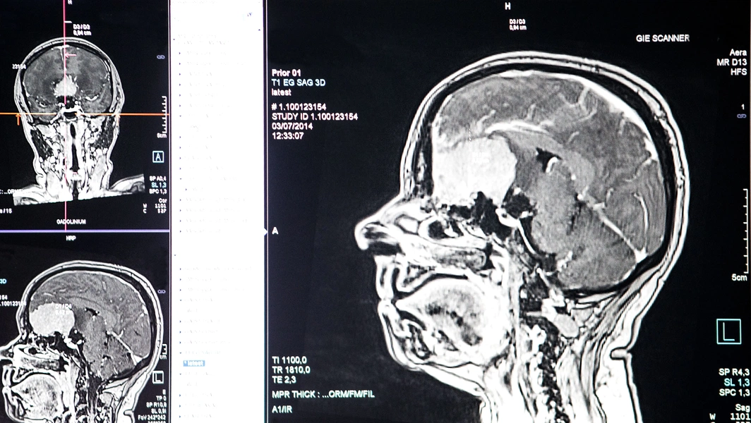 Spot the silent signs of brain tumours early