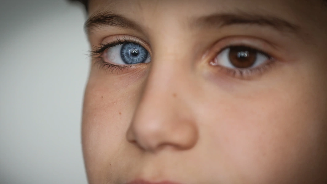 15 rare genetic traits and physical variations