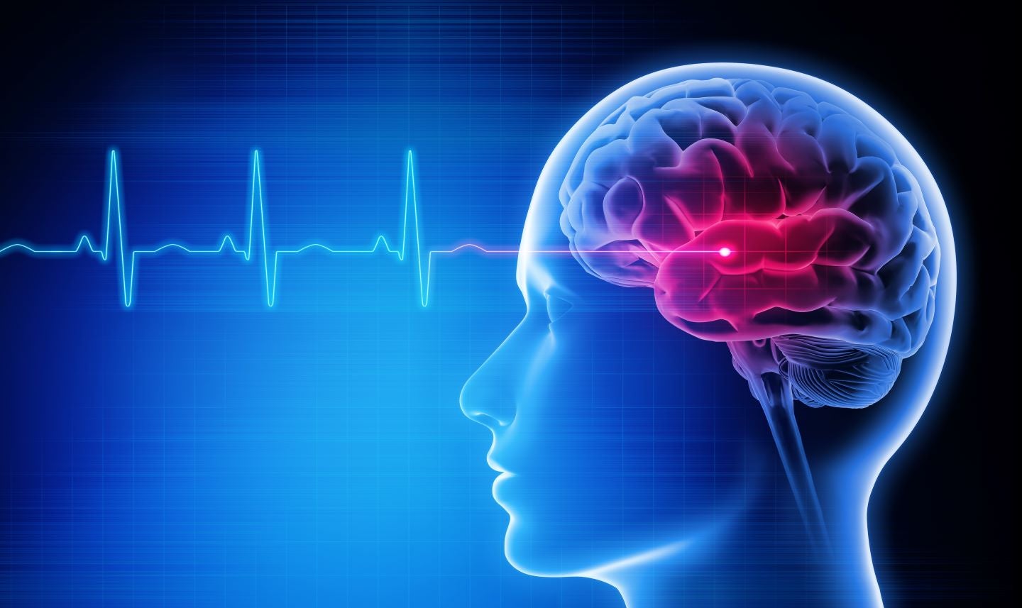Podcast: What the AHA-ASA’s updated guidelines mean for acute ischemic ...