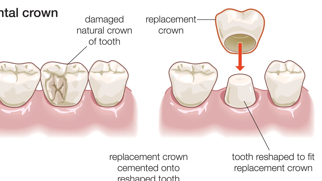 Comparing dental crowns and veneers