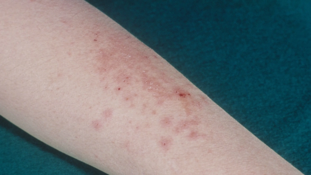 Recognizing the many faces of eczema
