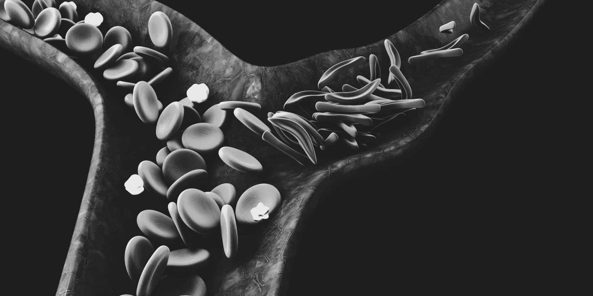 Everything you need to know about sickle cells and sickle cell disease
