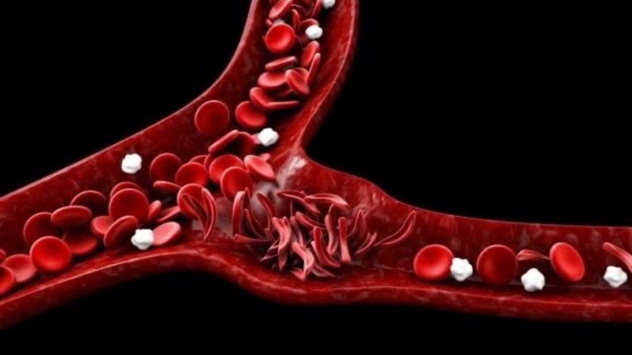 World Sickle Cell Day 2026: Haematologist explains how sickle-shaped ...