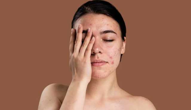 8 DIY remedies to treat dry skin in summers