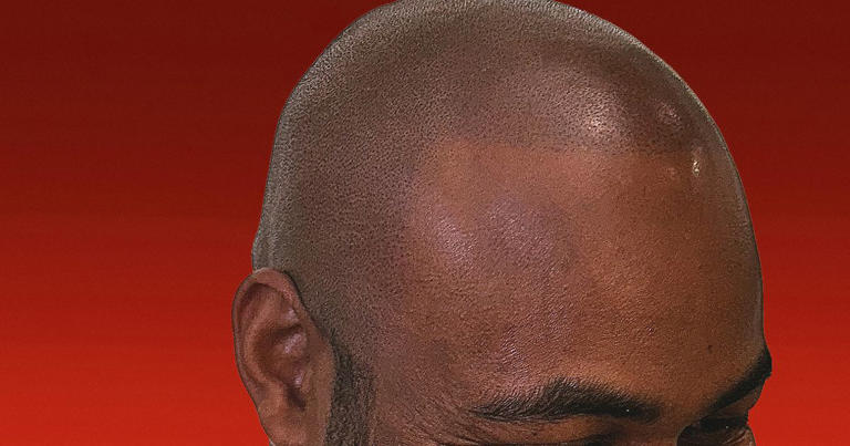 The nonsurgical way I got my hairline back