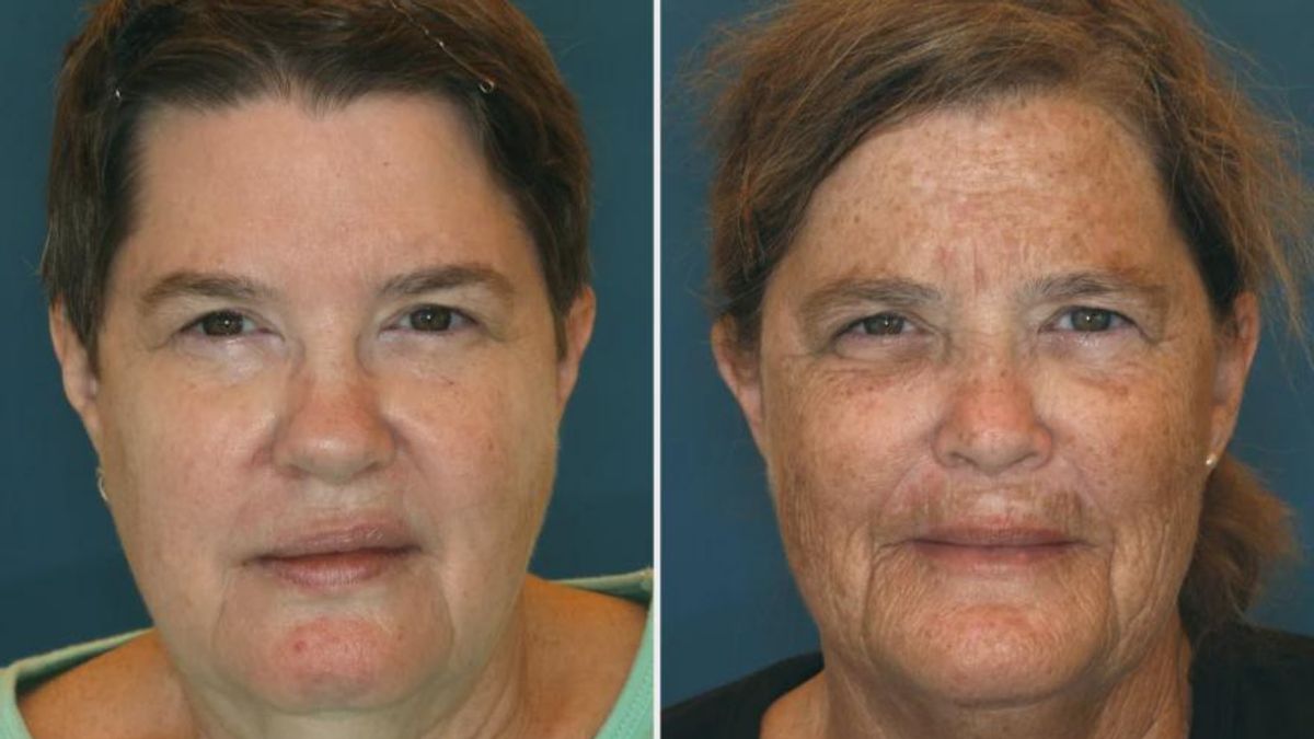 Do photos of identical twins show effects of sun exposure, smoking ...