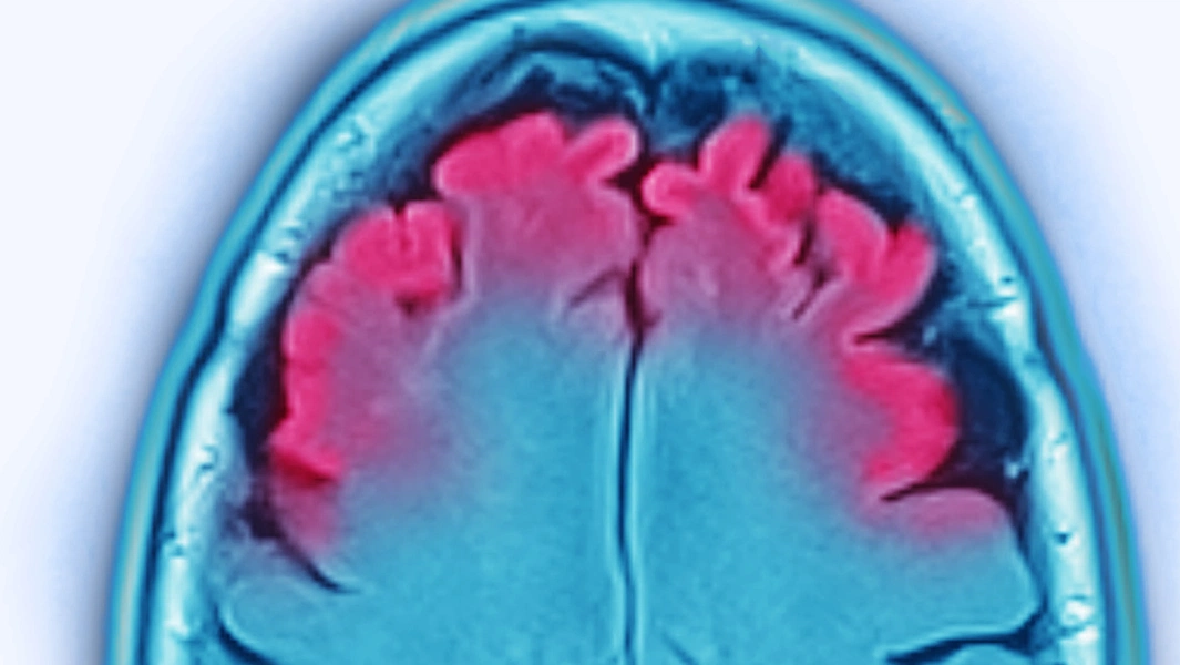 Neurologists outline five daily habits to protect brain health
