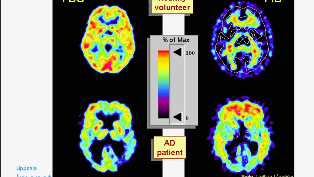 Neurologists outline five daily habits to protect brain health