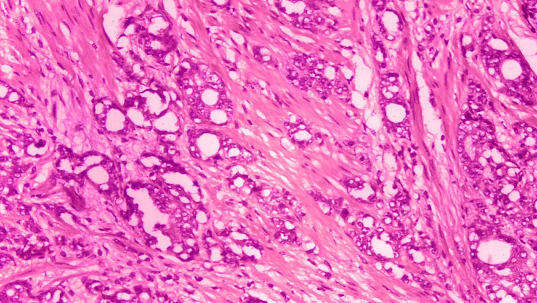 Understanding prostate cancer risks, detection, and care