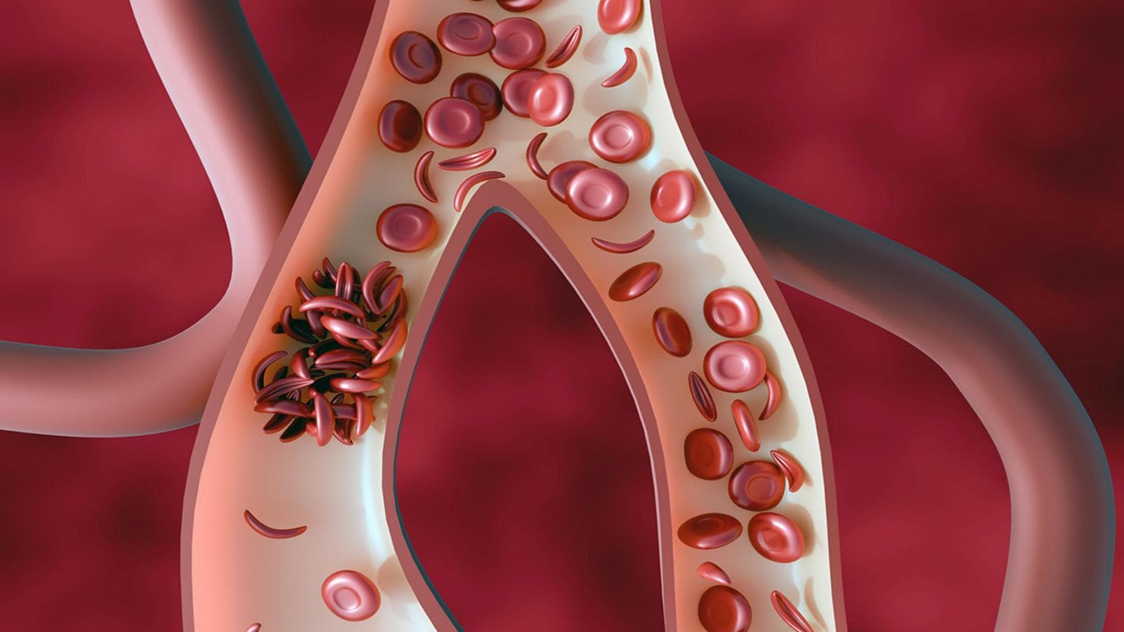 Common myths about sickle cell disease that can delay diagnosis