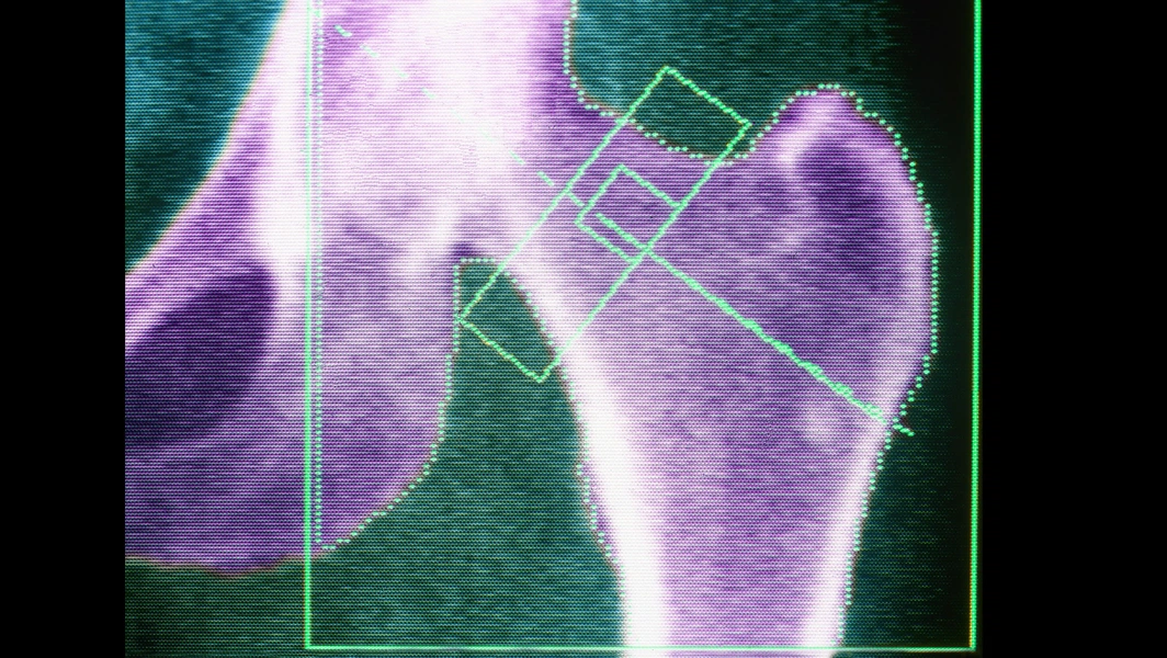 Experts outline nutrient-rich diet to strengthen bones
