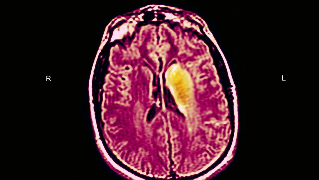 6 early stroke signs you might miss