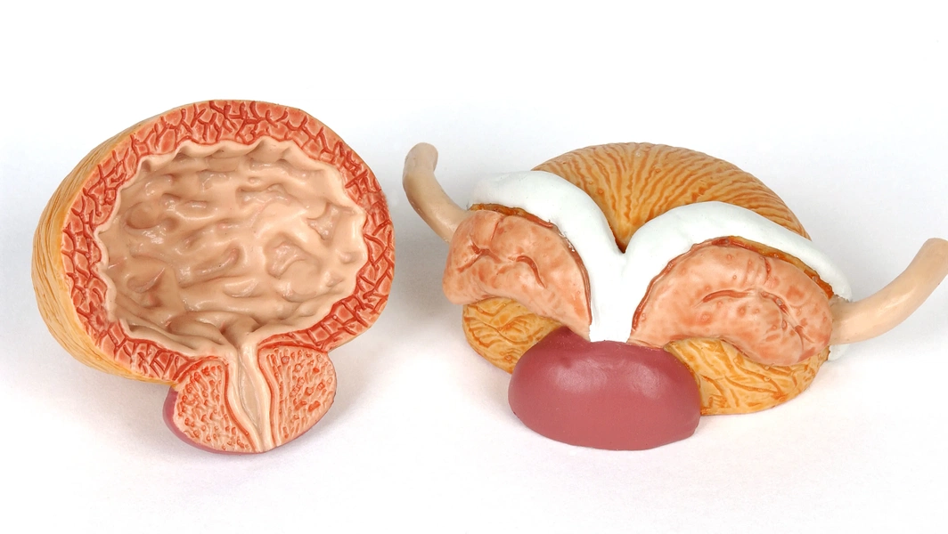 Managing urinary incontinence after prostate cancer