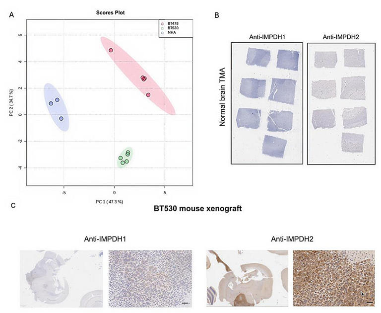 Targeting enzyme could block cancer spread to brain with fewer side effects
