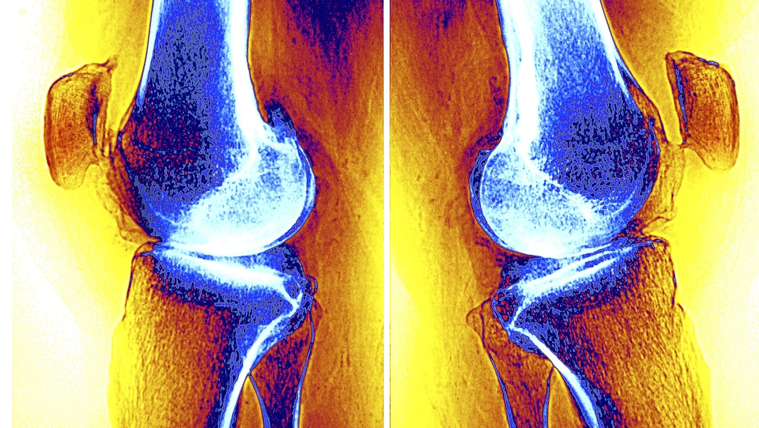 Minimally invasive relief for knee osteoarthritis