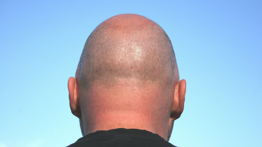 Bald positivity movement challenges hair loss stigma