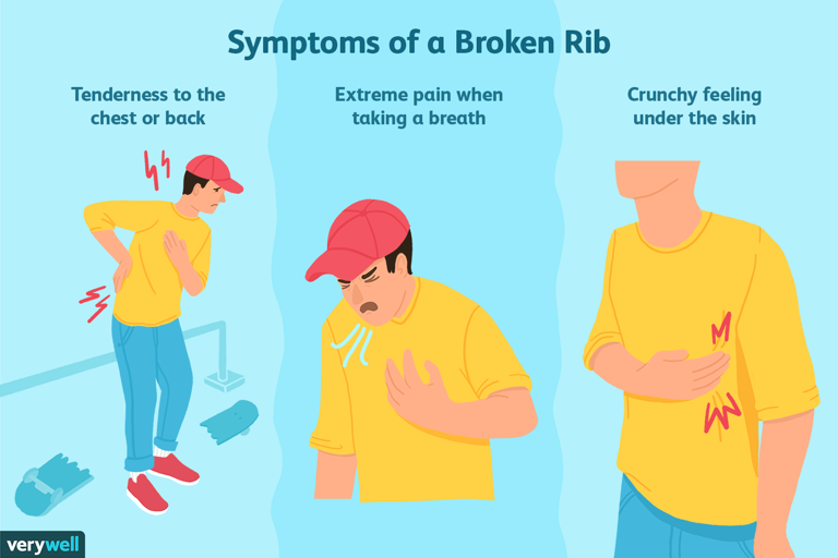 What is a cracked rib?