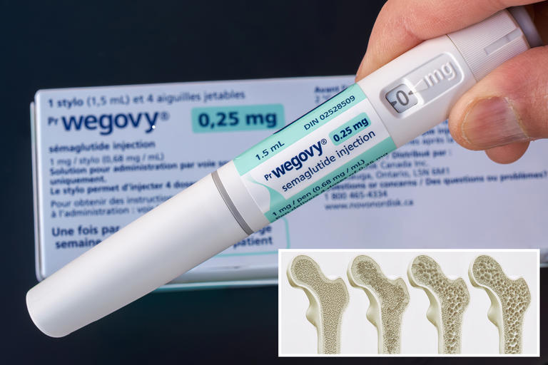 Ozempic and Wegovy may strengthen bones in type 2 diabetes patients ...