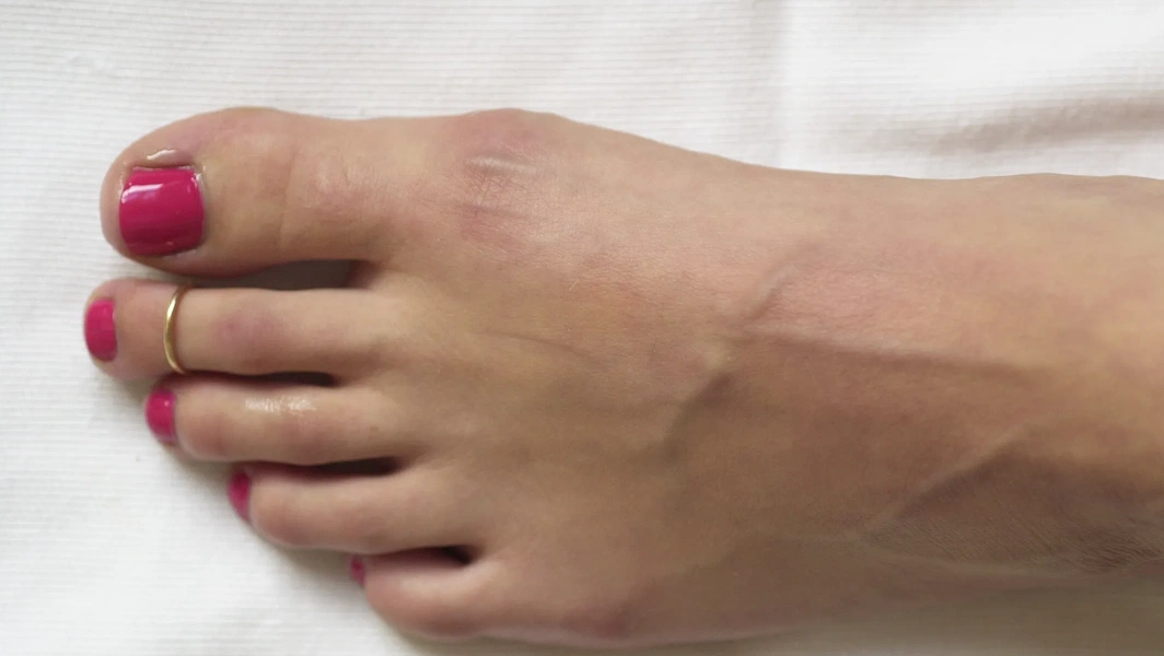 Toe hair changes and what they reveal about health