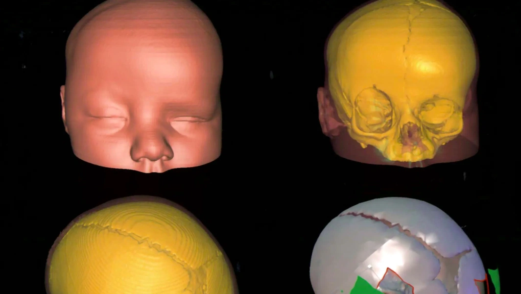 Pediatric skull disorders and surgical solutions
