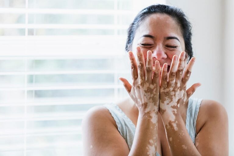 White patches on the skin: Is it vitiligo, a fungal infection, or ...